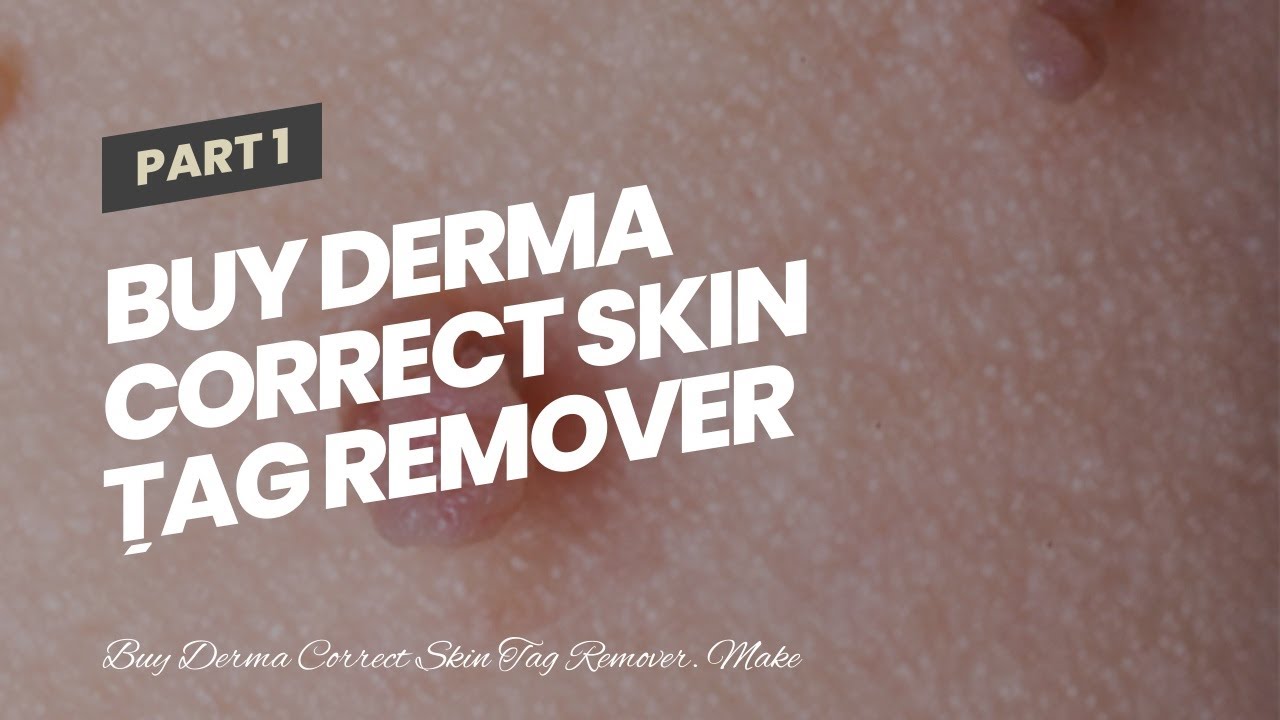 Buy Derma Correct Skin Tag Remover (UPDATE: What They Don't Tell You!)